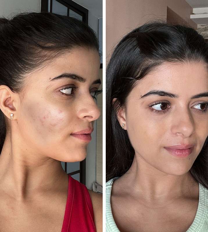 Get Plix 2% Salicylic Acid Serum for Active Acne & Blackheads