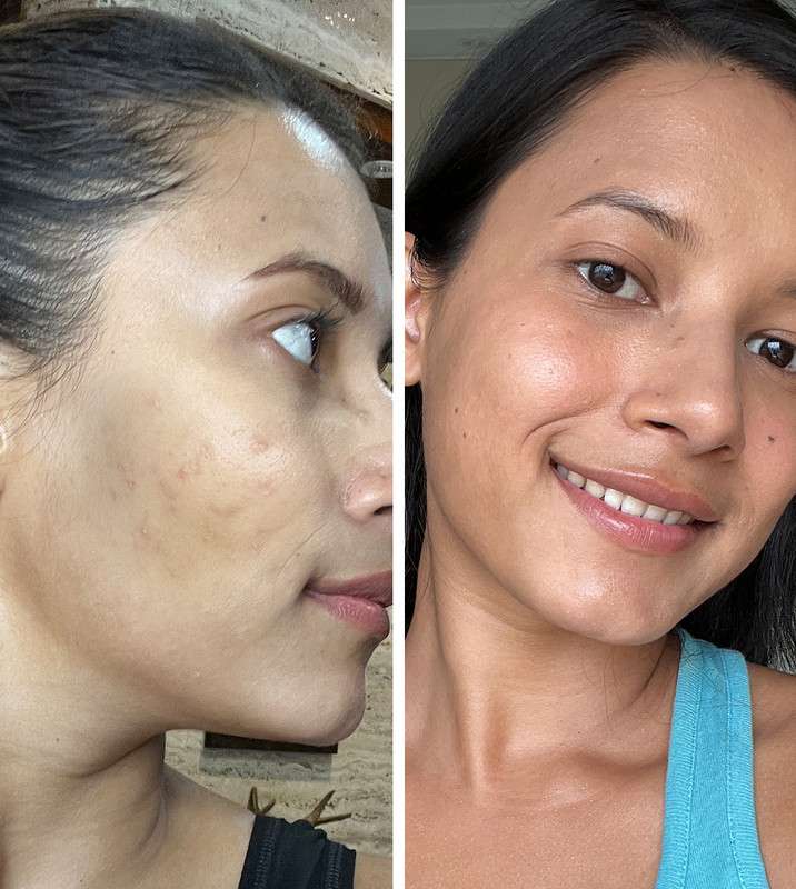 Get Plix 2% Salicylic Acid Serum for Active Acne & Blackheads