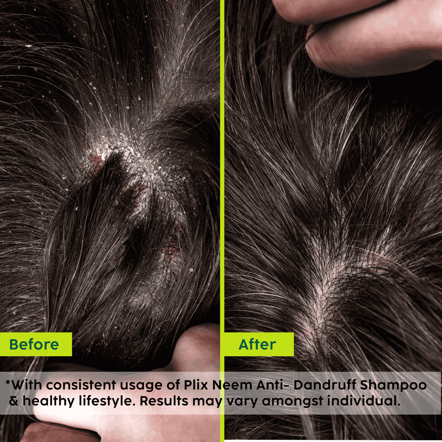 Neem Anti-Dandruff Advanced Shampoo (For Reduced Dandruff & Itchiness)