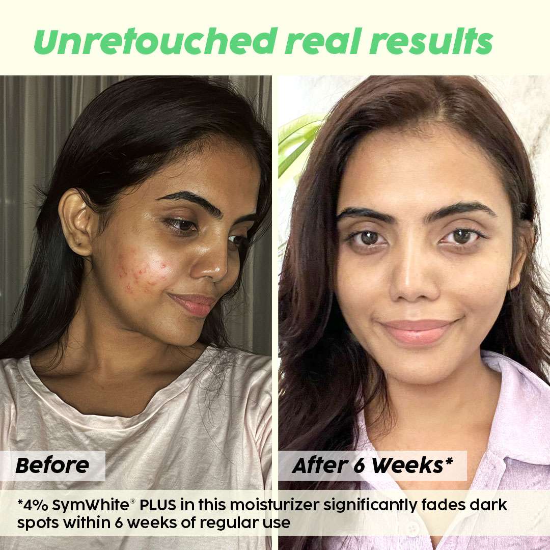 Get plix Face Pigmentation Cream For Dark Spots & Tan Removal