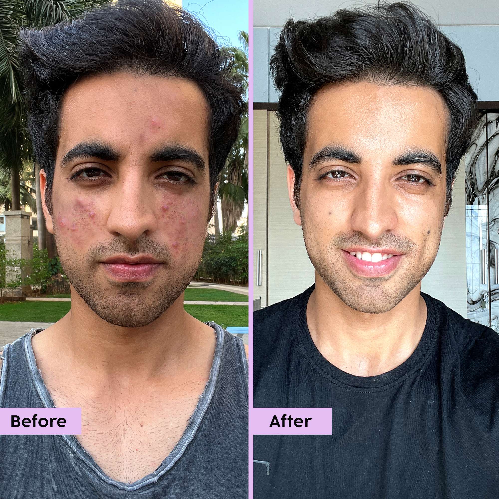 Jamun Active Acne Duo with Cleanser & Active Acne Serum