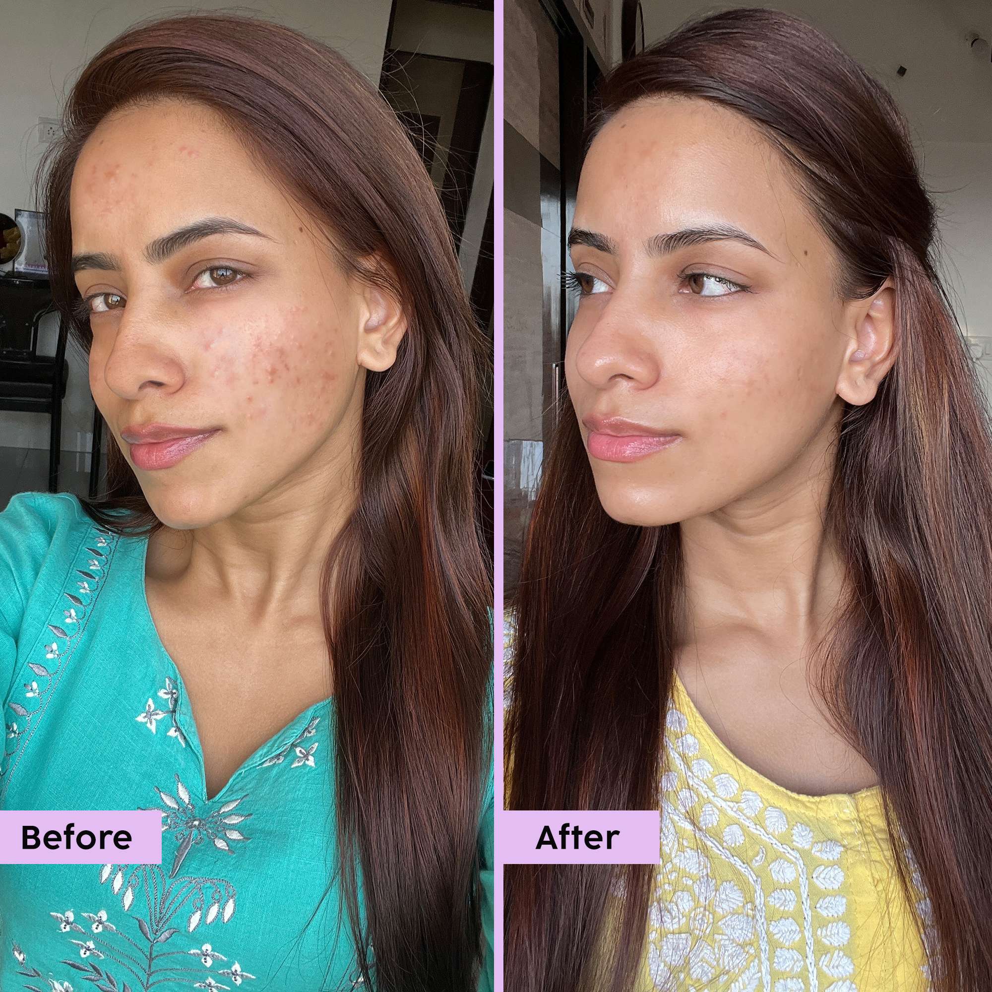 Jamun Active Acne Duo with Cleanser & Active Acne Serum