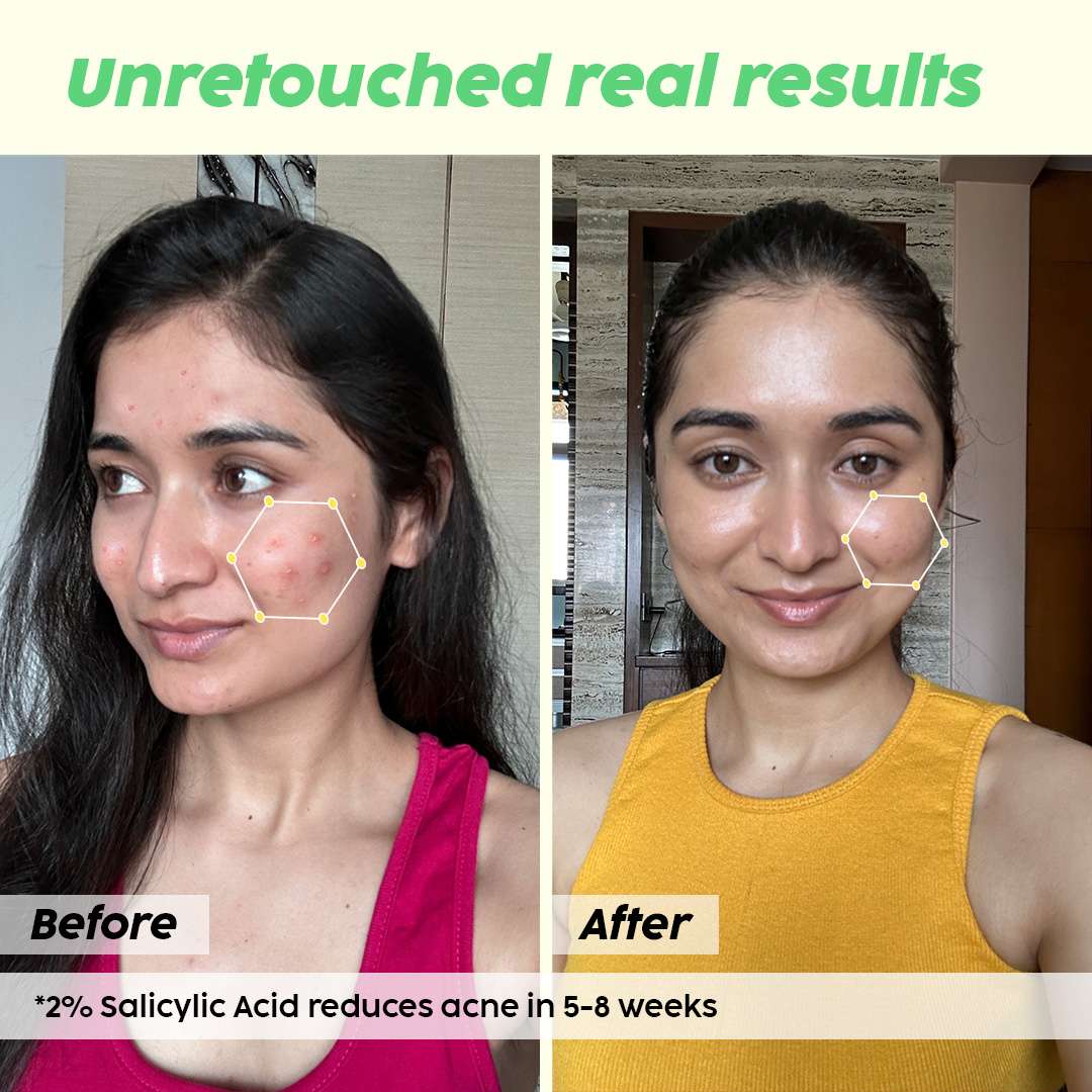 Buy Jamun Acne Spot Corrector Gel For Active Acne shop at Plix