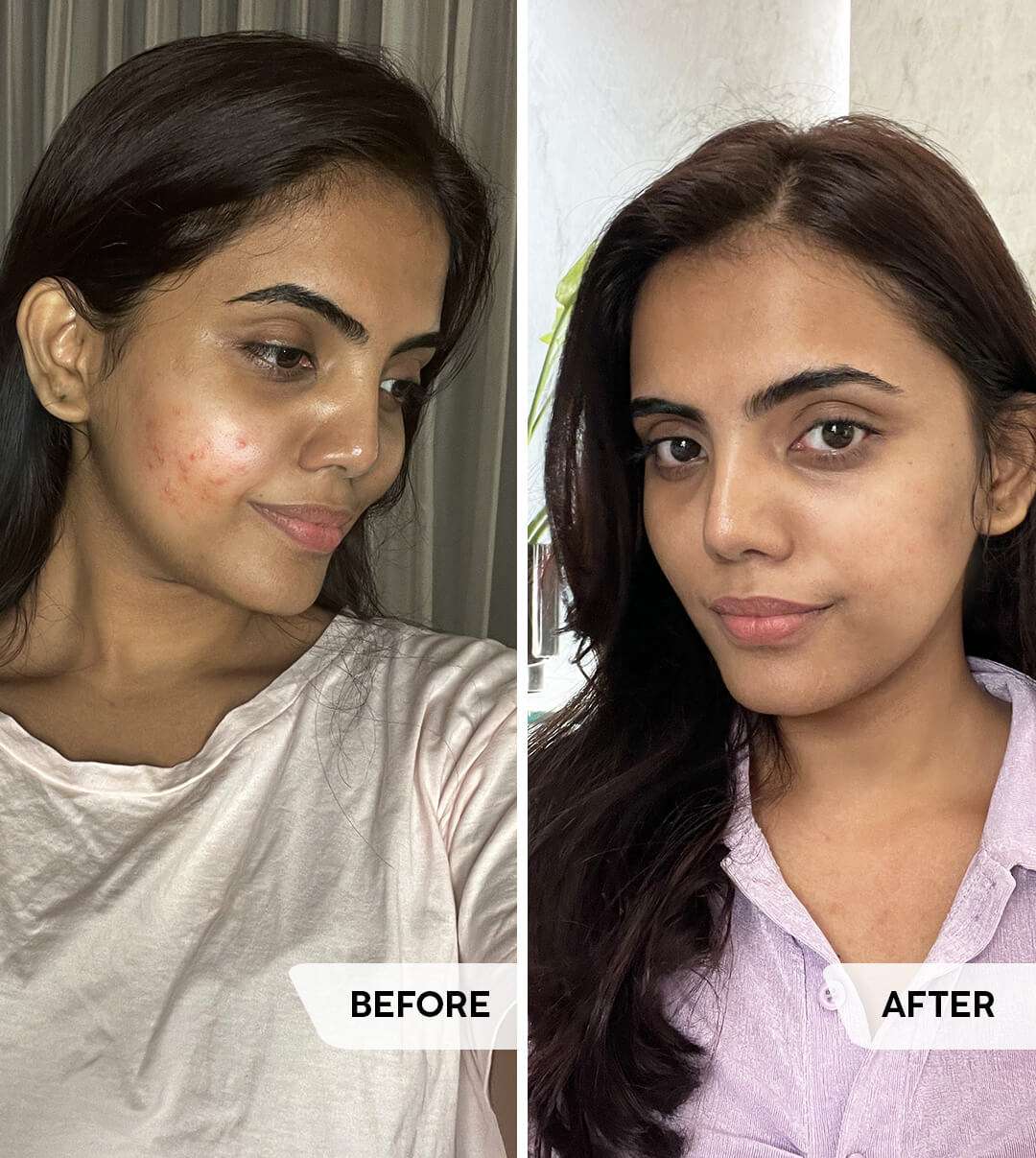 Buy Plix Acne Fighter- Acne Defense Formula for clear and brigther skin